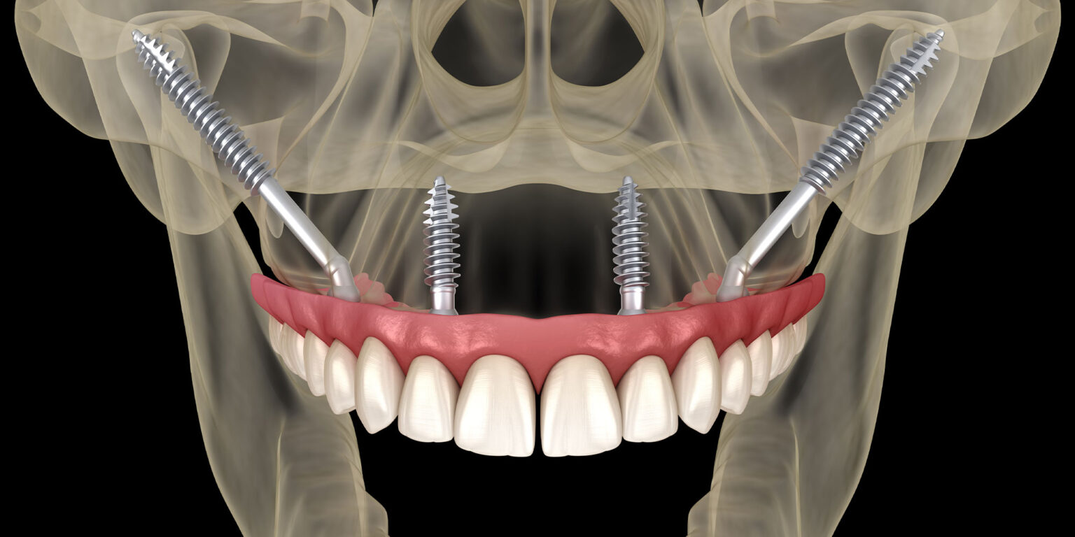 Zygomatic Implants | San Angelo & Brownwood, TX | Angelo Oral Surgery ...